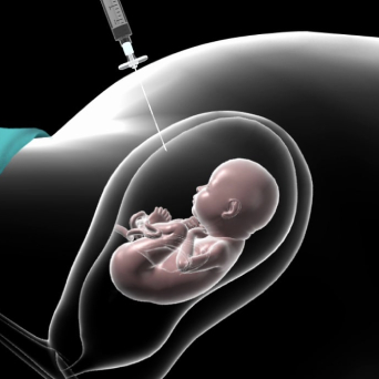 Amniocentesis - Racham Fetal Medicine